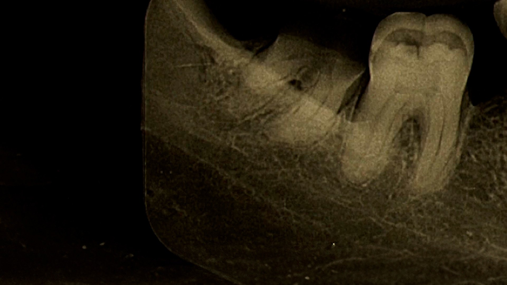 Trilha Exodontia de Restos Radiculares | iDent