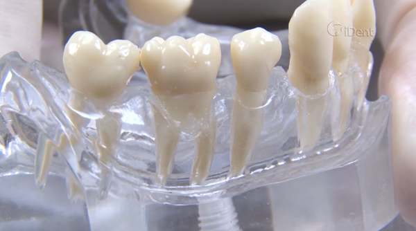 Assista online: Aprenda a usar: BoneCeramic da Straumann | Ident