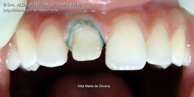 Coroa em Cerômero no 11, Caso clínico | Ident