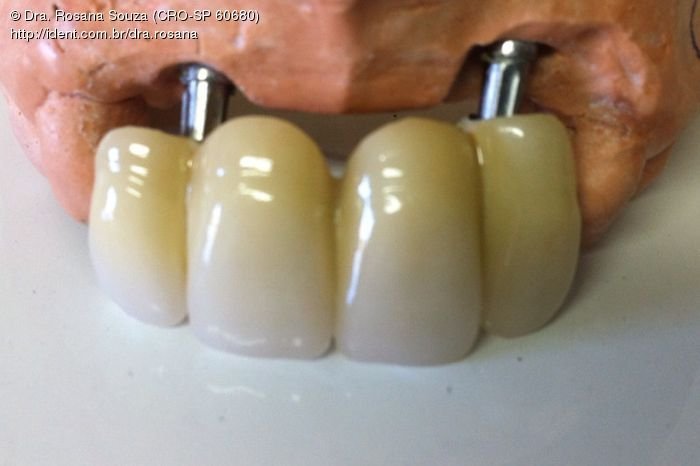 Prótese Fixa Sobre Implantes, Caso clínico | Ident