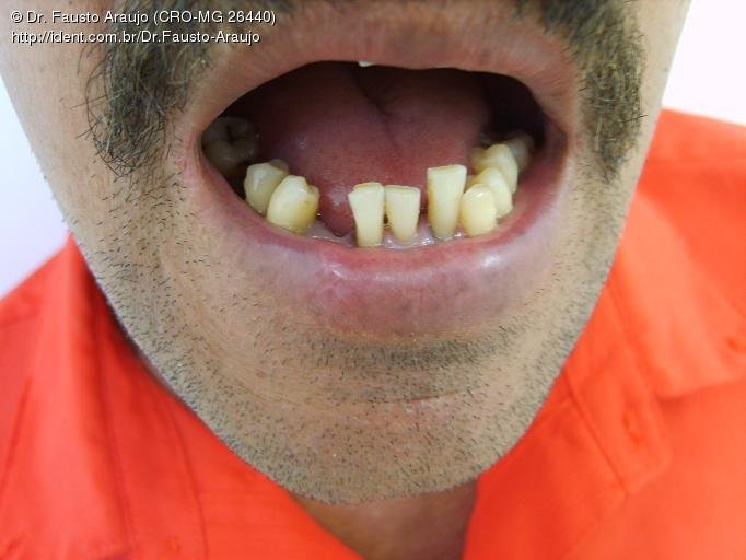 Varicosidade em Lábio Inferior, Caso clínico | Ident