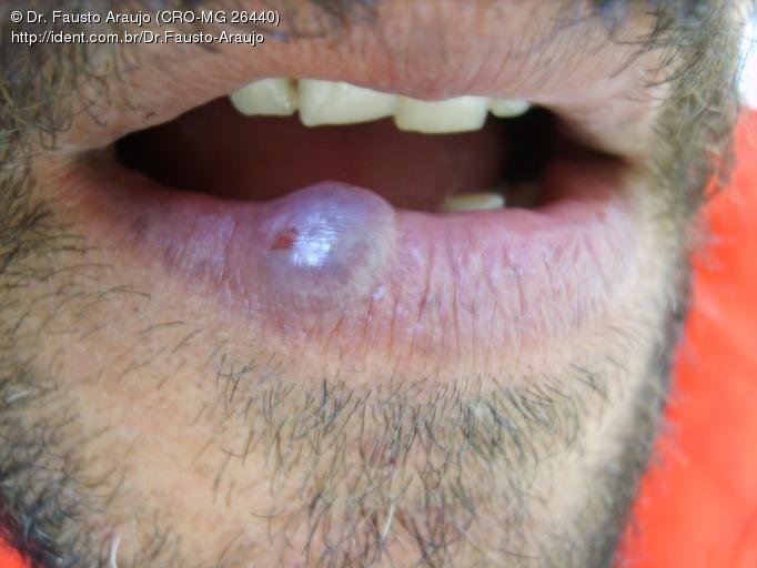 Varicosidade em Lábio Inferior, Caso clínico | Ident