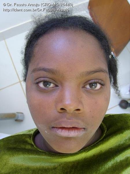 Displasia Ectodérmica Hipoidrótica - Síndrome de Christ-Siemes-Touraine ...