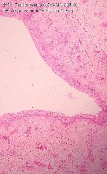 Cisto da Papila Incisiva, Caso clínico | Ident