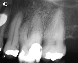 Canal Dente 26, Caso clínico | Ident
