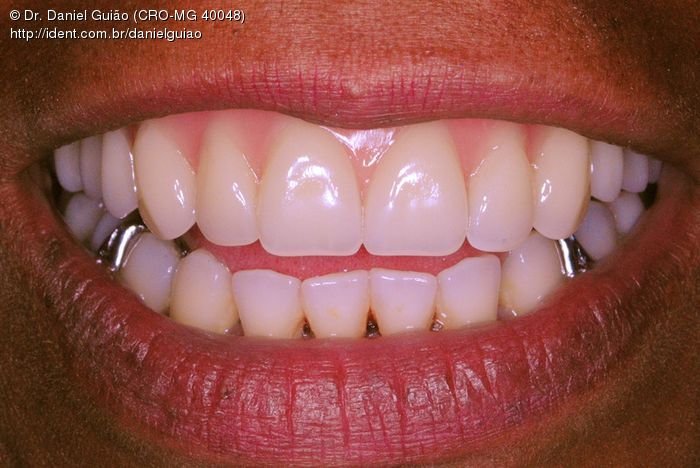 Substituição de Ptr Superior e Confecção de Ppr Inferior, Caso clínico ...