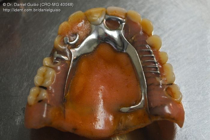 Substituição de Ptr Superior e Confecção de Ppr Inferior, Caso clínico ...