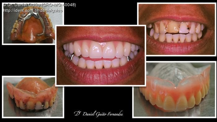 Substituição de Ptr Superior e Confecção de Ppr Inferior, Caso clínico ...