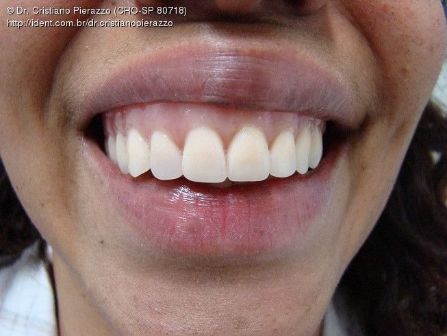Provisório Sobre Dentes e Implante., Caso clínico | Ident