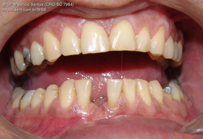 Prótese Fixa Adesiva Metalo-Cerâmica, Caso clínico | Ident