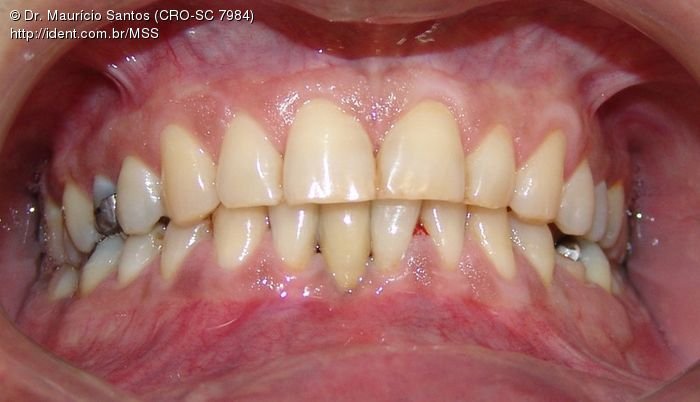 Prótese Fixa Adesiva Metalo-Cerâmica, Caso clínico | Ident