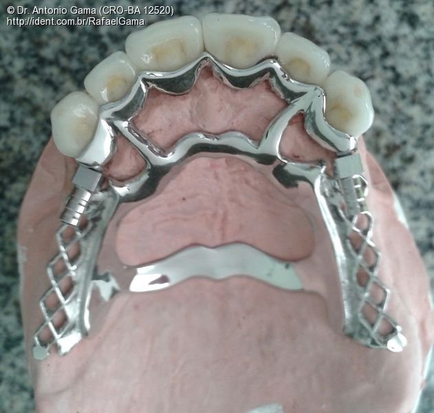 Prótese Fixa e Removível com Encaixe., Caso clínico | Ident