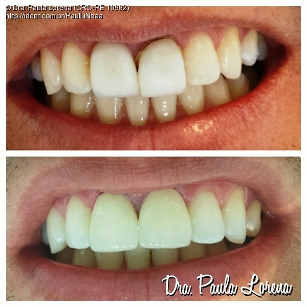 Prótese Fixa, Caso clínico | iDent