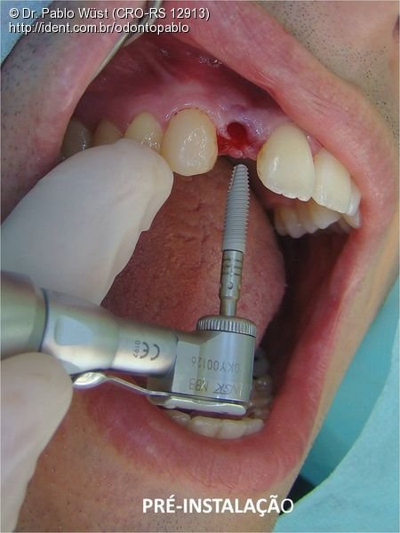 Implante Imediato Unitário Anterior, Caso clínico | Ident