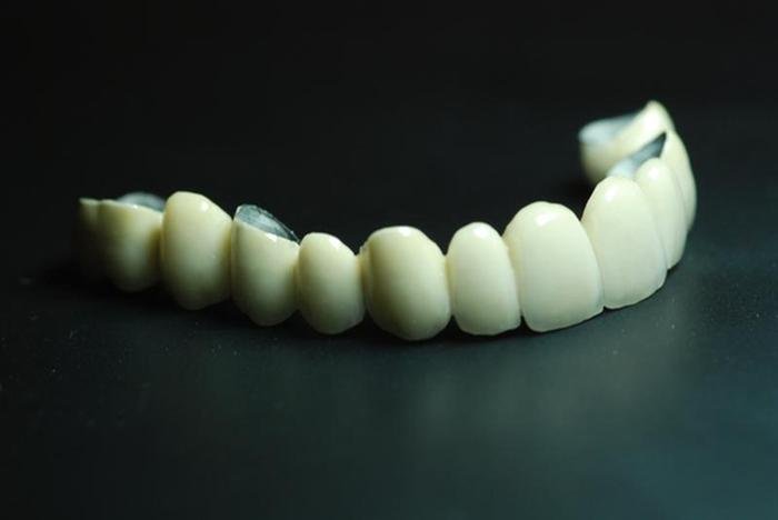 Prótese Fixa Metalocerâmica com 11 Elementos., Caso clínico | Ident