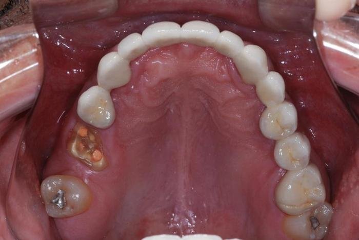 Prótese Fixa Metalocerâmica com 11 Elementos., Caso clínico | Ident