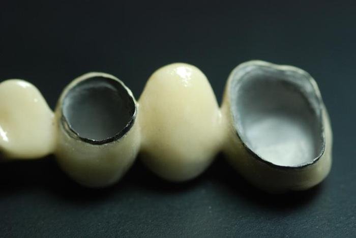 Prótese Fixa Metalocerâmica com 11 Elementos., Caso clínico | Ident