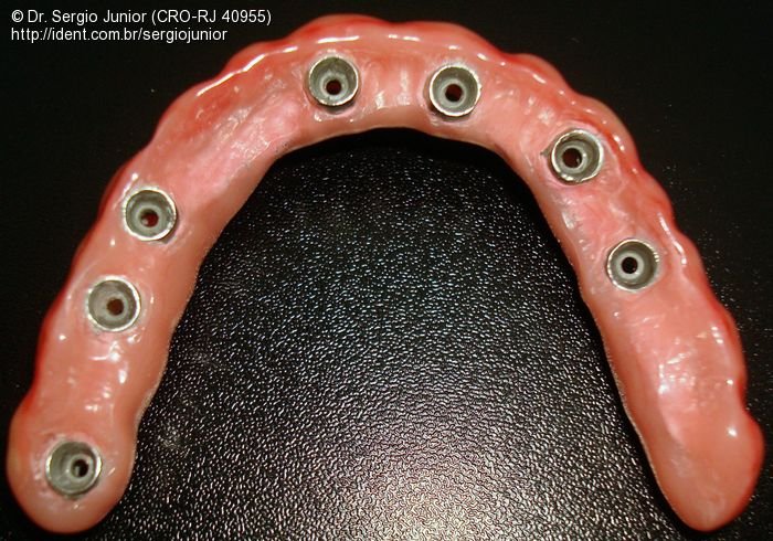 Protocolo Superior - Fase Prótese, Caso clínico | iDent