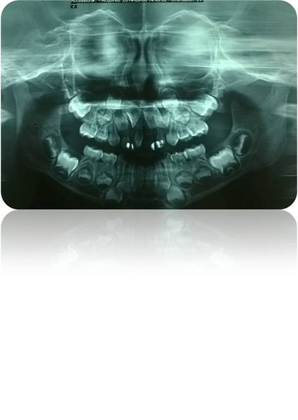 Dente Supranumerário( Mesiodente ), Caso clínico | Ident