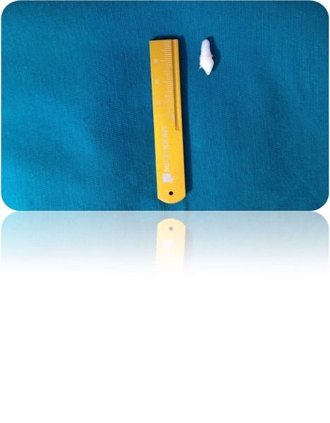 Dente Supranumerário( Mesiodente ), Caso clínico | Ident