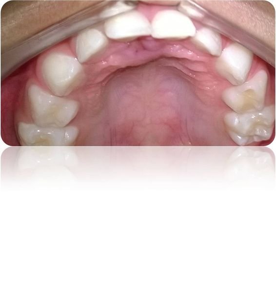 Dente Supranumerário( Mesiodente ), Caso clínico | Ident