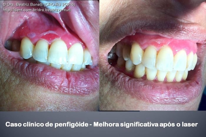 Controle de Penfigóide Benigno das Mucosas com Laserterapia- Relato de ...