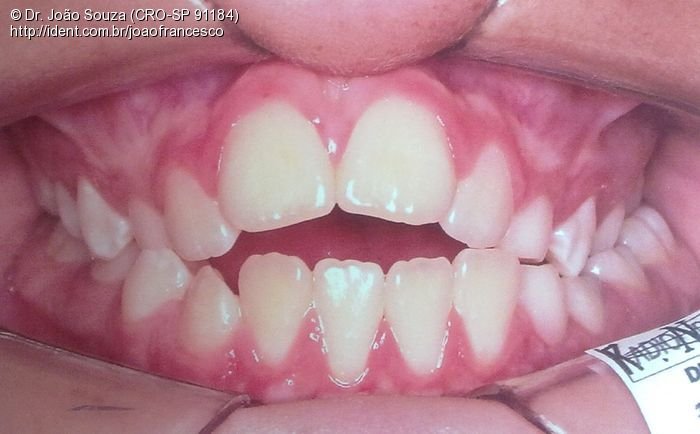 Caso com Atresia de Maxila e Mordida Aberta Anterior., Caso clínico | Ident