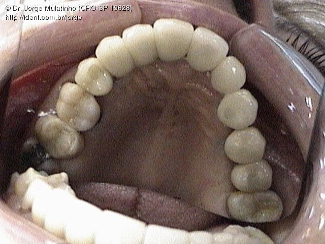 Proteses Fixas Cimentadas e Parafusadas, Caso clínico | Ident