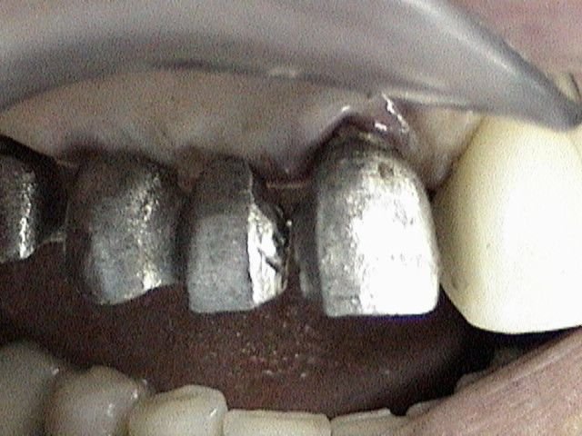 Proteses Fixas Cimentadas e Parafusadas, Caso clínico | Ident