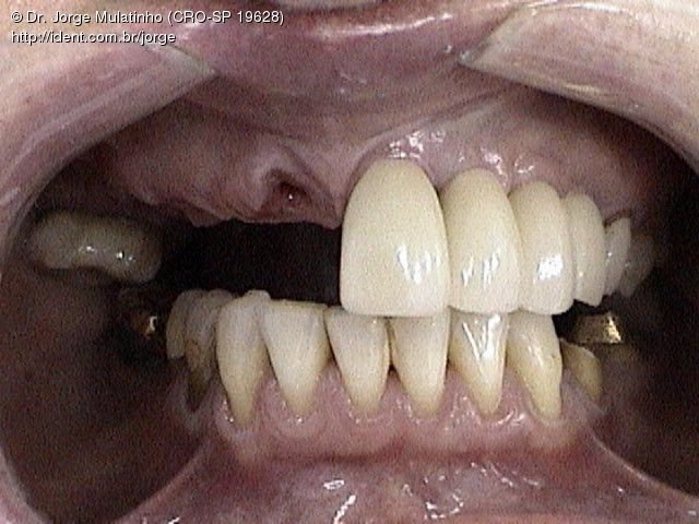 Proteses Fixas Cimentadas e Parafusadas, Caso clínico | Ident
