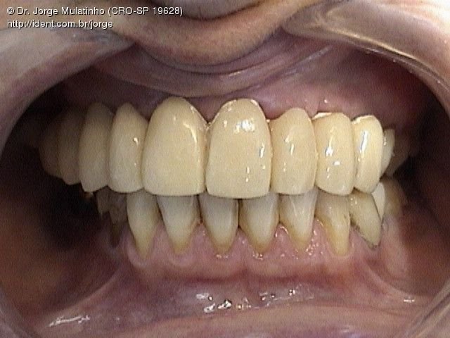 Proteses Fixas Cimentadas e Parafusadas, Caso clínico | Ident