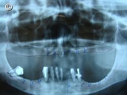 Protocolo com Função Imediata Utilizando Implantes de Corpo Único, Caso ...