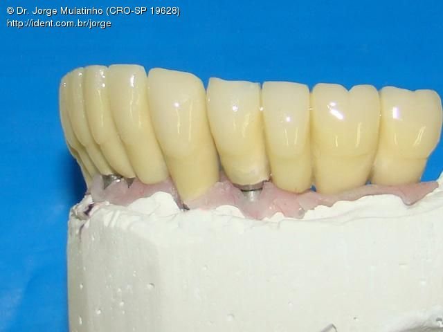 Utilizacao de Implantes de Corpo Unico, Caso clínico | Ident