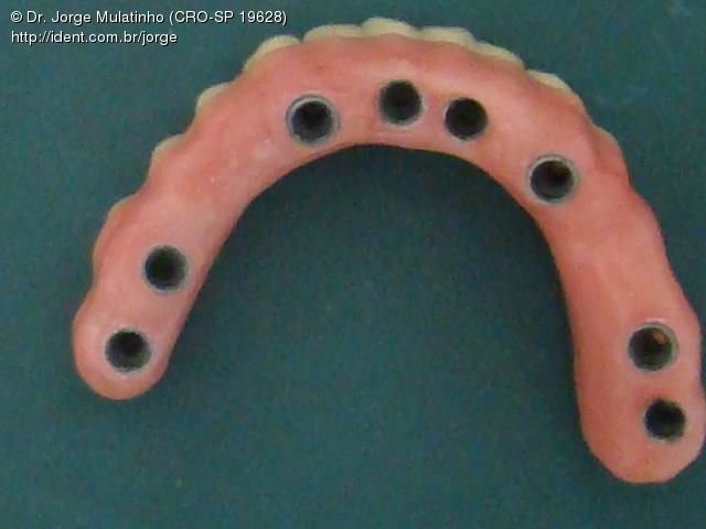 Utilizacao de Implantes de Corpo Unico, Caso clínico | Ident