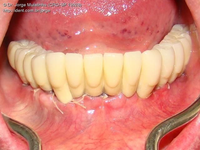 Utilizacao de Implantes de Corpo Unico, Caso clínico | Ident