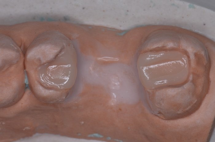 Protocolo de Confecção de Prótese Adesiva em Resina Composta Reforçada ...