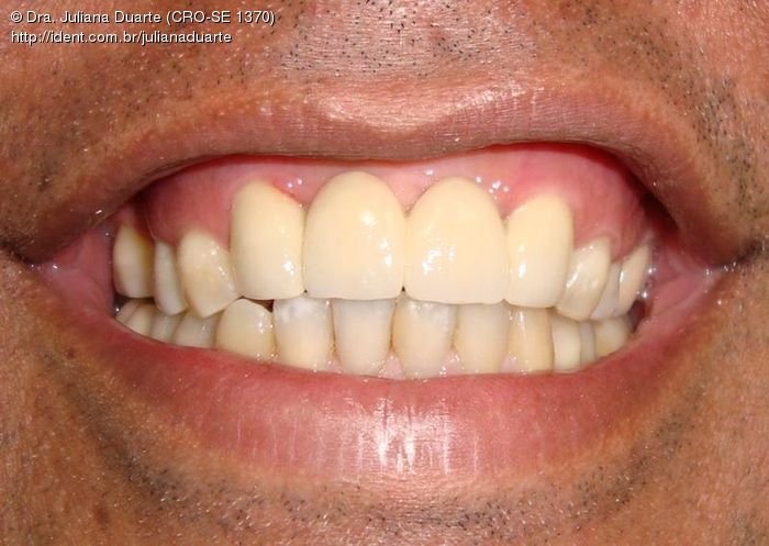 Prótese Fixa 4 Elementos, Caso clínico | Ident