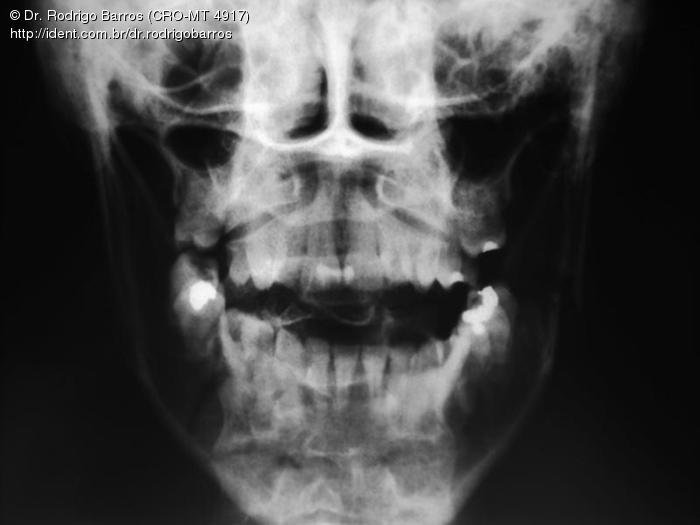 (Trauma) Fratura Bilateral de Mandibula, Caso clínico | Ident