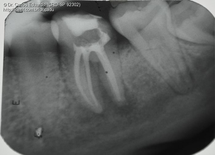 Tratamento Endodontico Dente 46 - Necropulpectomia Ii, Caso clínico | Ident