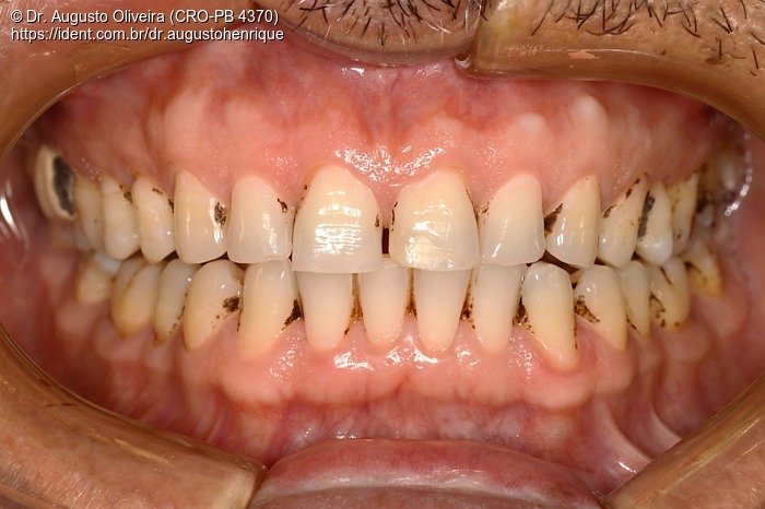 Você Sabe o Que São Bactérias Cromogênicas?, Caso clínico | Ident