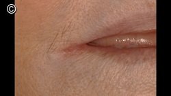 Queilite: Como Abordar?, Caso clínico | Ident